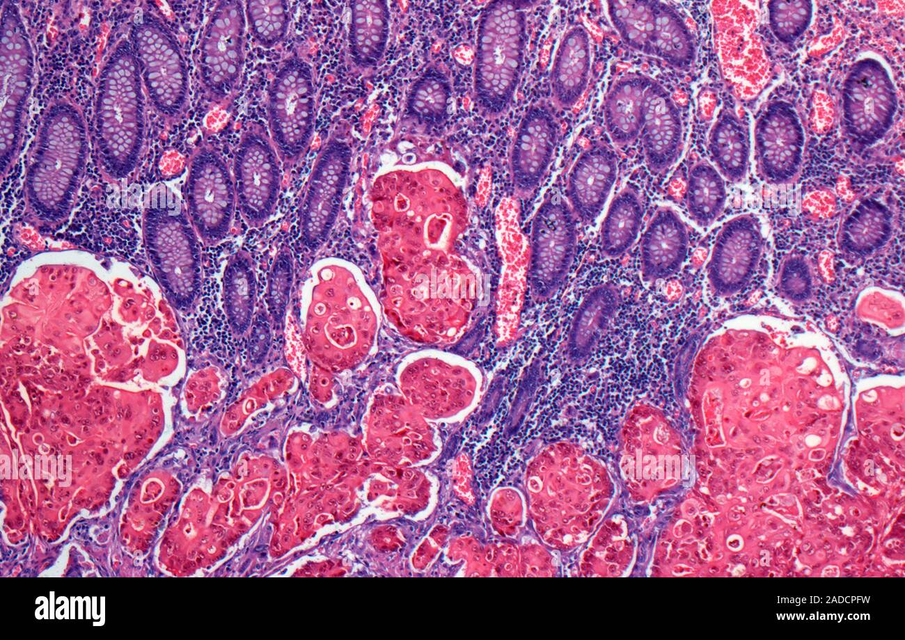 Colon cancer. Light micrograph (LM) of a section through an ...