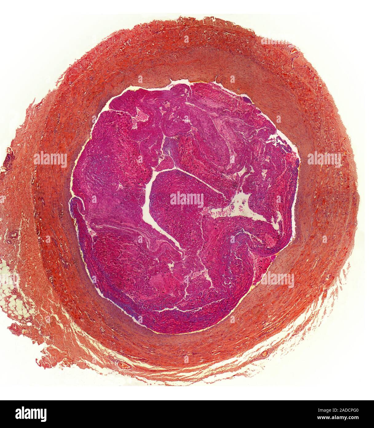 Arterial thrombosis. Light micrograph (LM) of a section through a ...