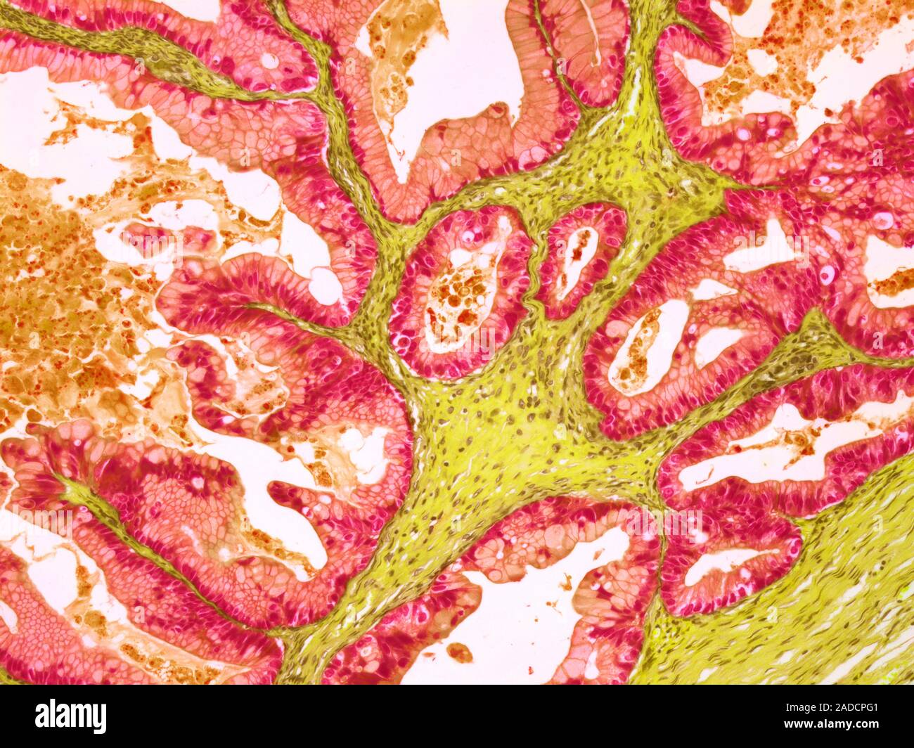 Ovarian Tumour Light Micrograph Lm Of A Section Through An Ovary Showing A Mucinous