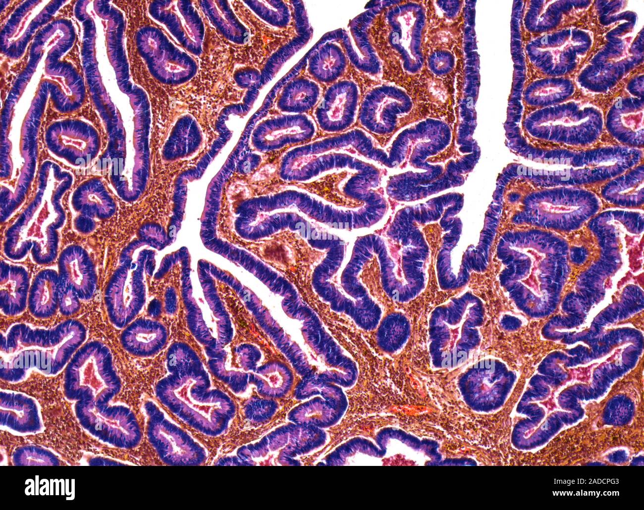 Colon cancer. Light micrograph (LM) of a section through an ...