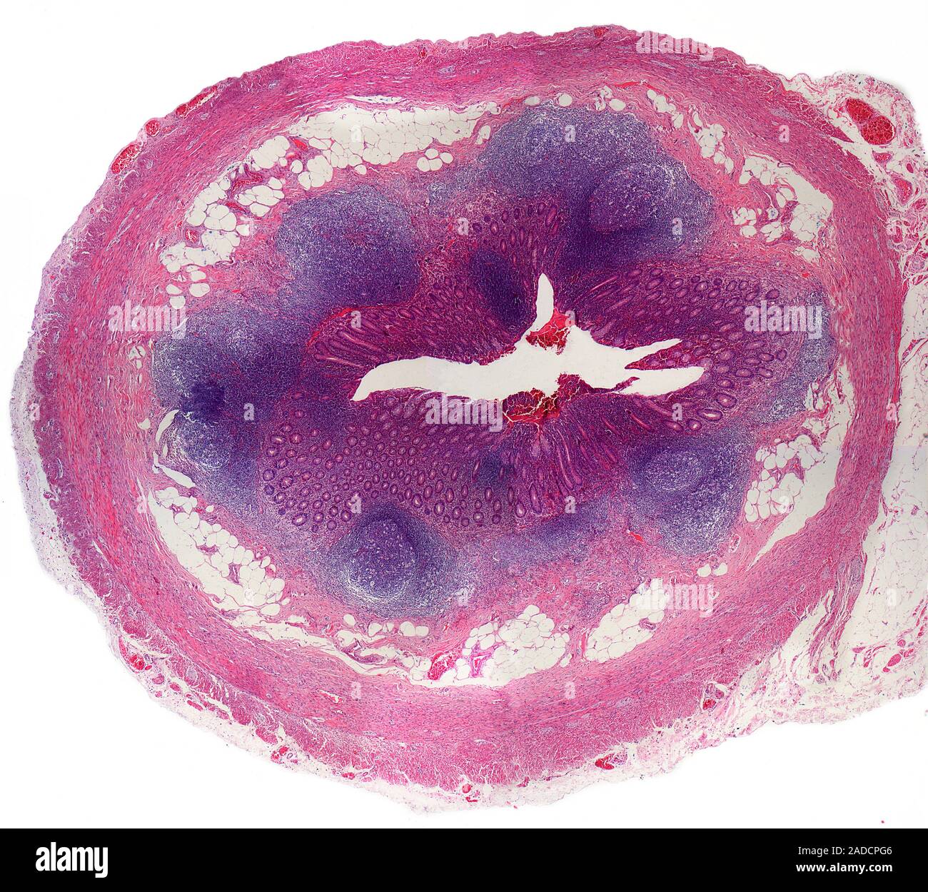 Acute Appendicitis Light Micrograph Lm Of A Section Through An Appendix That Has Been Removed