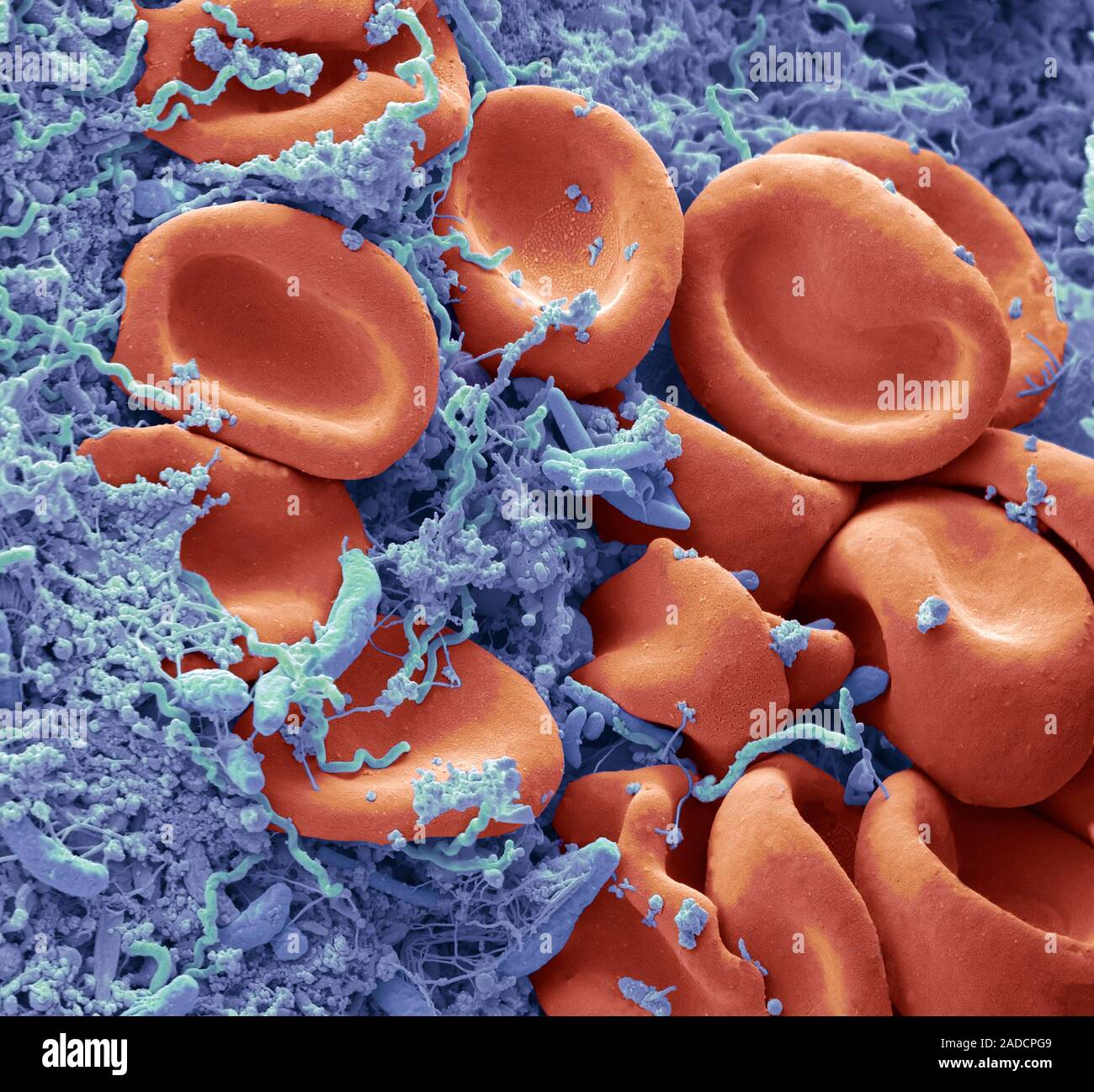 Bleeding gums. Scanning electron micrograph (SEM) of blood from ...