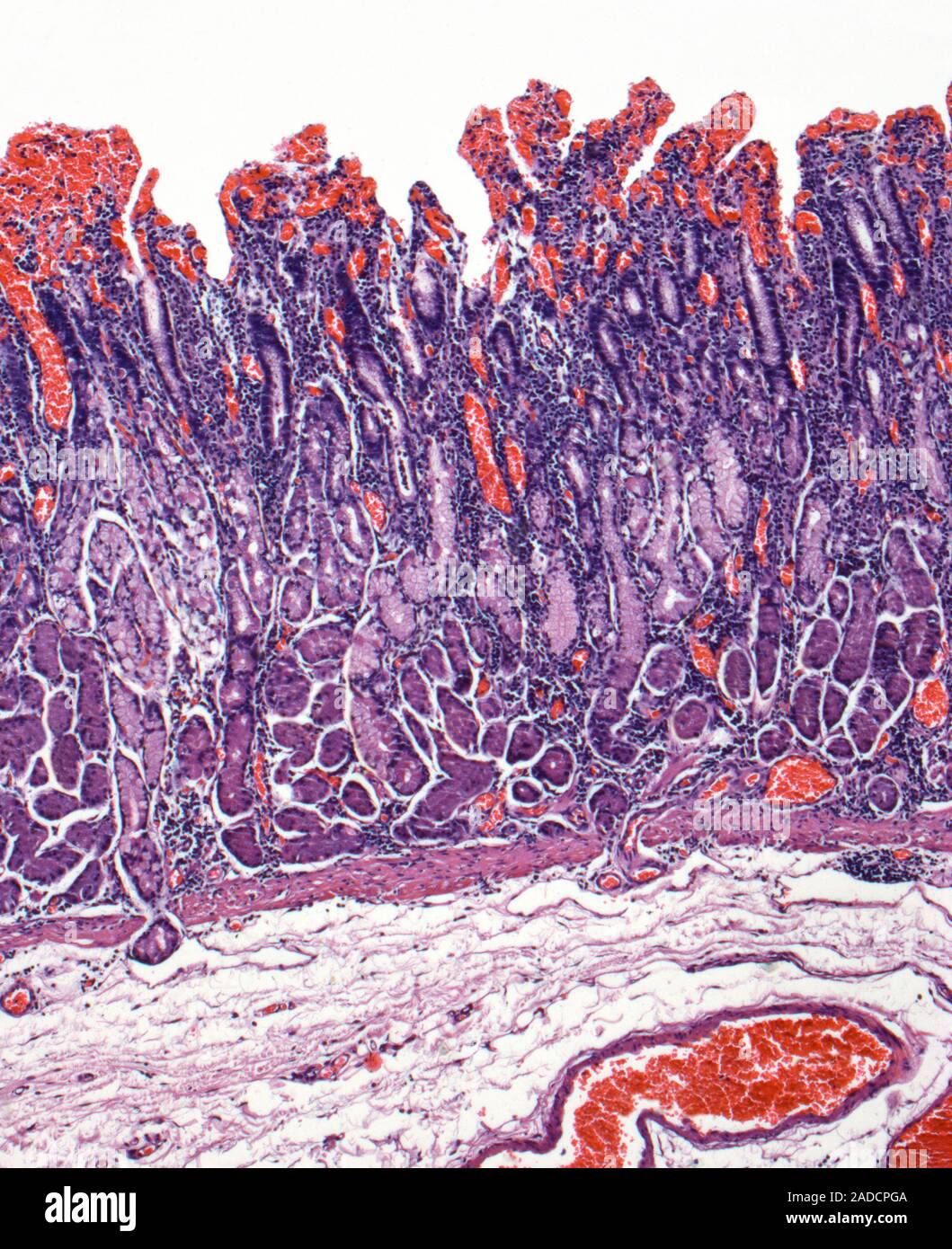Gastritis. Light micrograph (LM) of a section through the lining of the ...