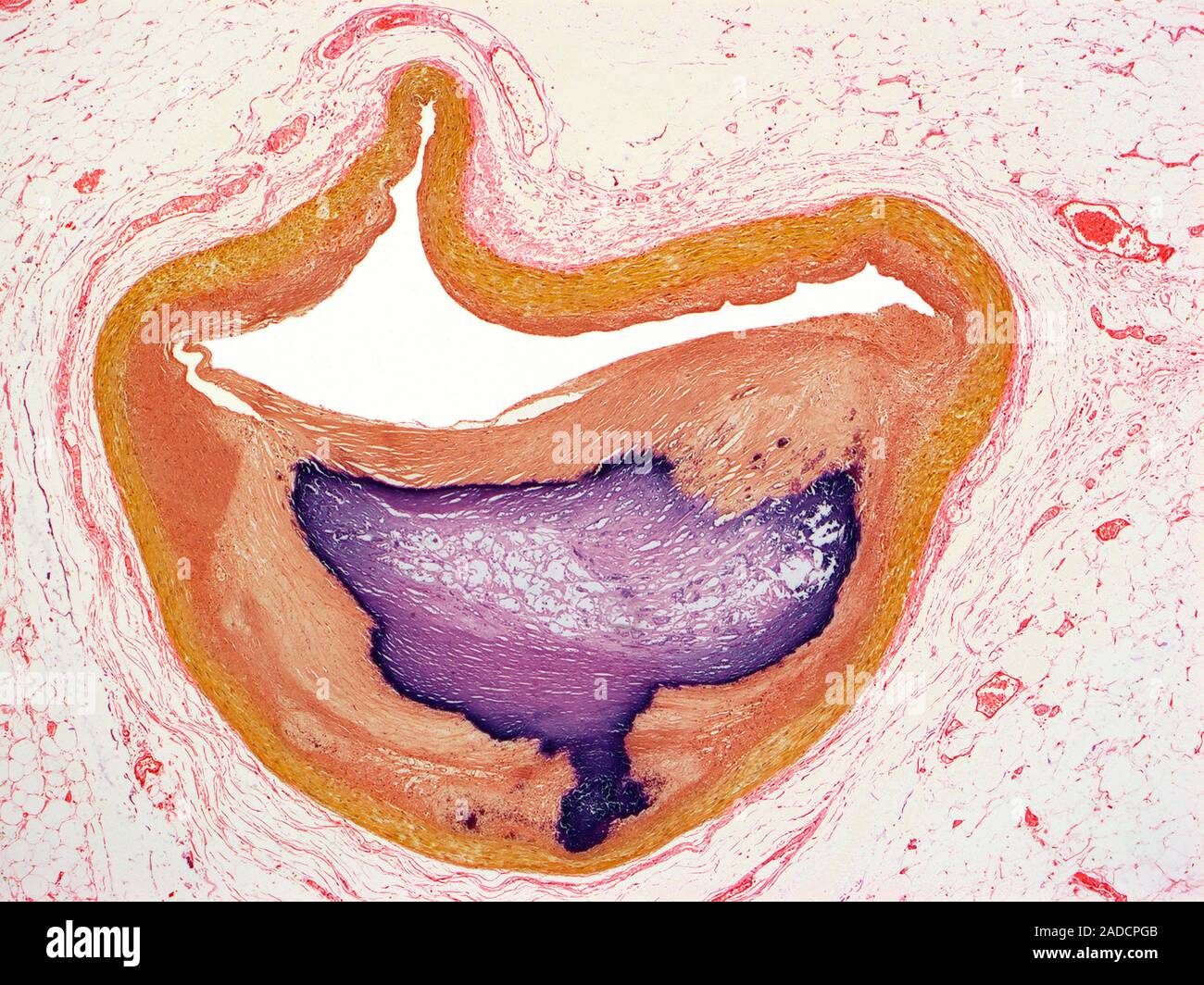 Atherosclerosis. Light micrograph (LM) of a section through an artery ...