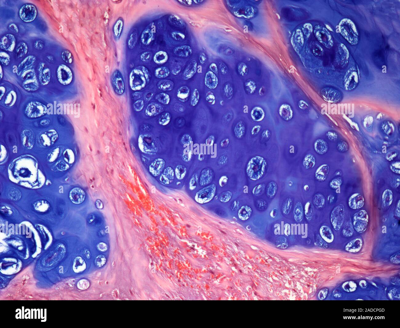 Bone cancer. Light micrograph (LM) of a section through a ...