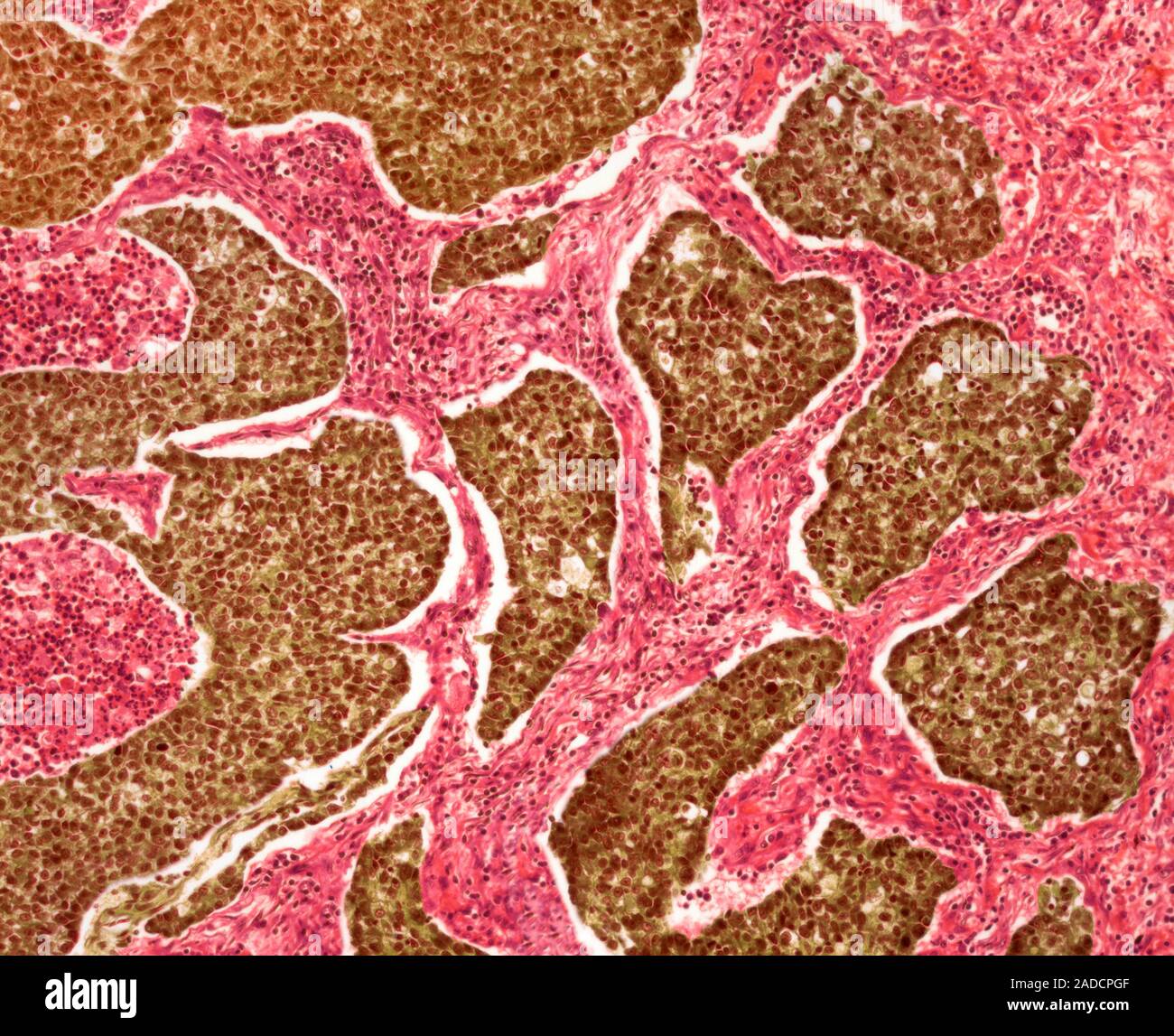 Lung cancer. Light micrograph (LM) of a section through a squamous cell ...