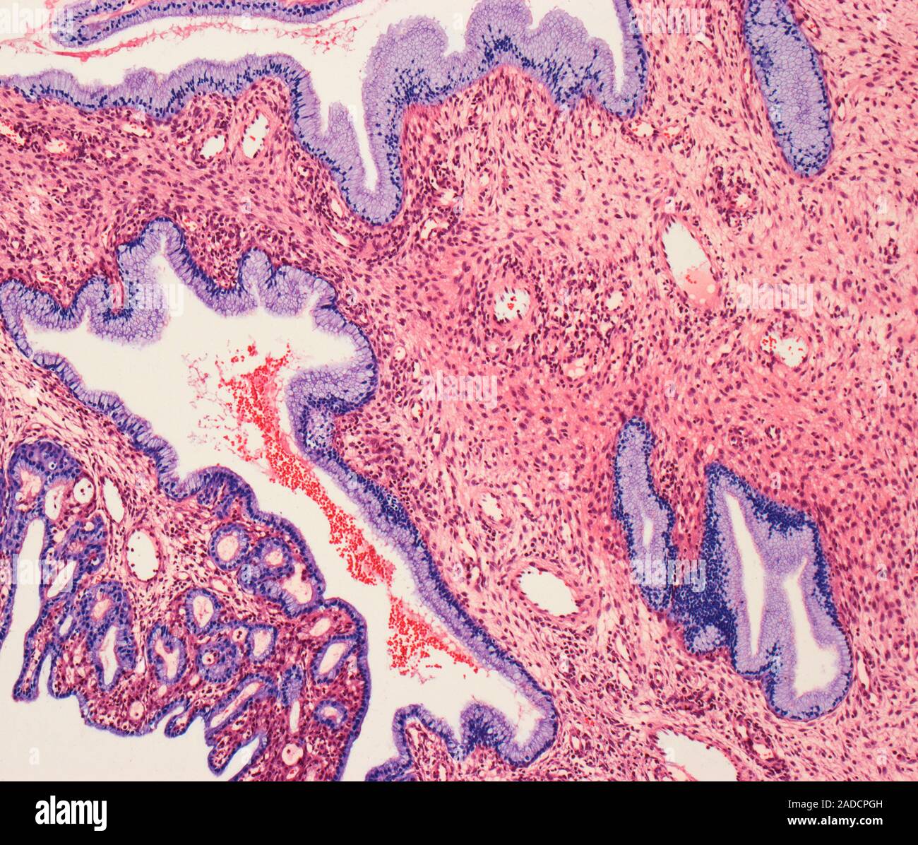 Nasal polyp. Light micrograph (LM) of a section through a nasal polyp ...