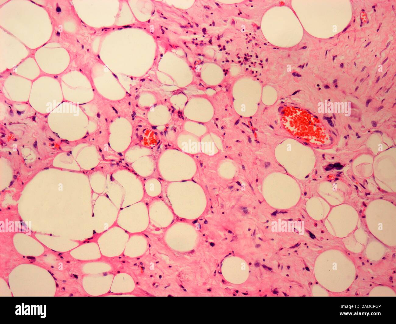 Connective tissue cancer. Light micrograph of a section through a ...