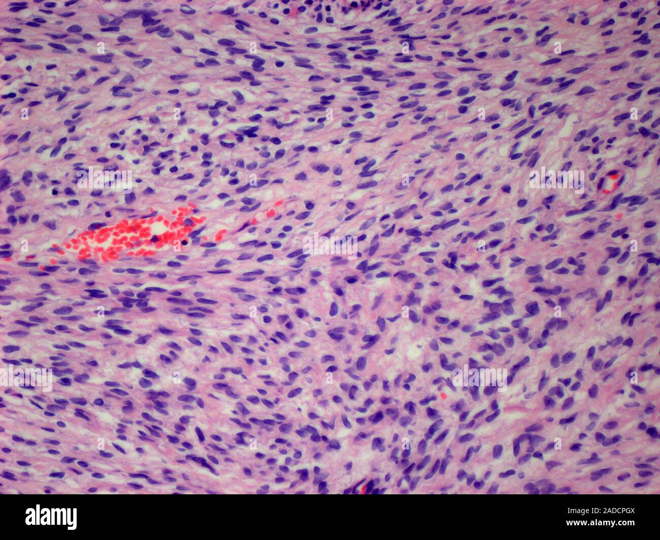 Fibroma. Light micrograph (LM) of a fibroma. Fibromas (or fibroid ...