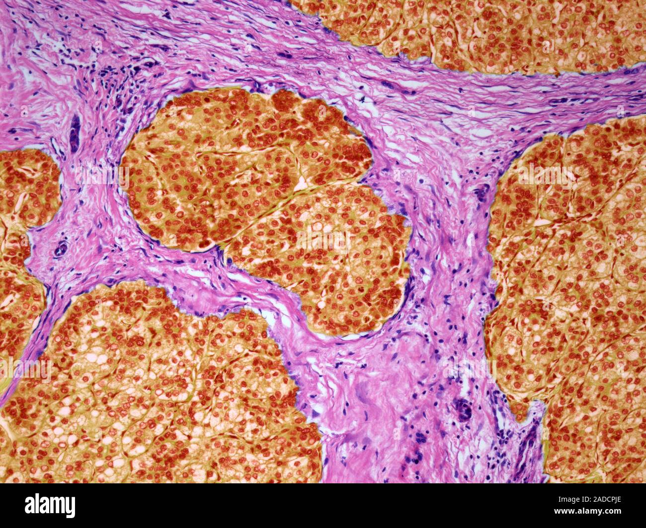 Hepatocellular carcinoma. Light micrograph (LM) of a section through a ...