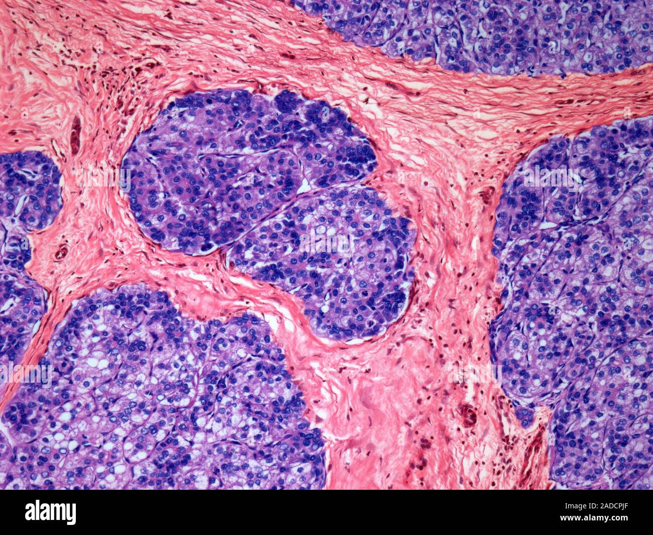Hepatocellular carcinoma. Light micrograph (LM) of a section through a ...