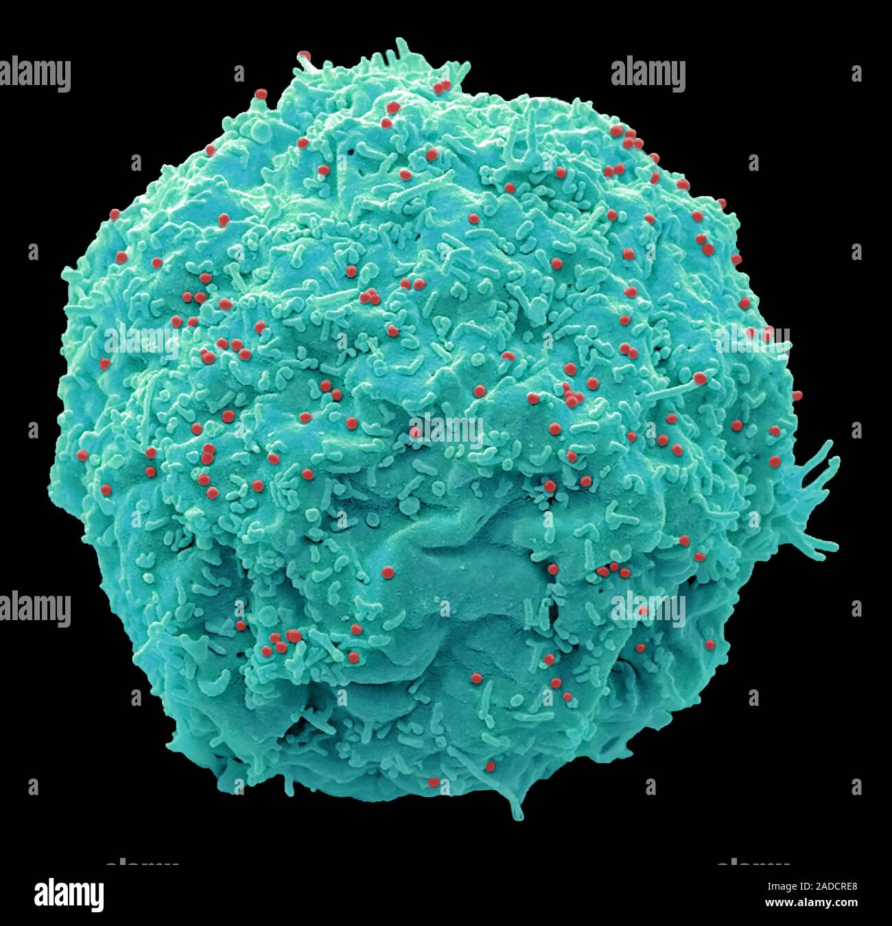 HIV infected 293T cell. Coloured scanning electron micrograph (SEM) of ...