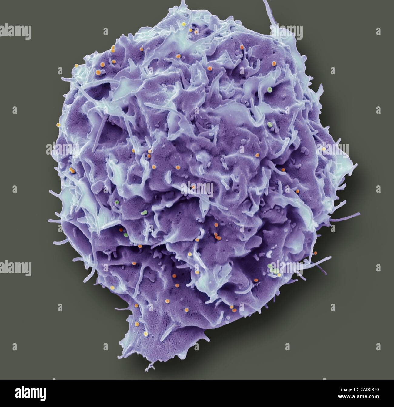 HIV infected 293T cell. Coloured scanning electron micrograph (SEM) of ...