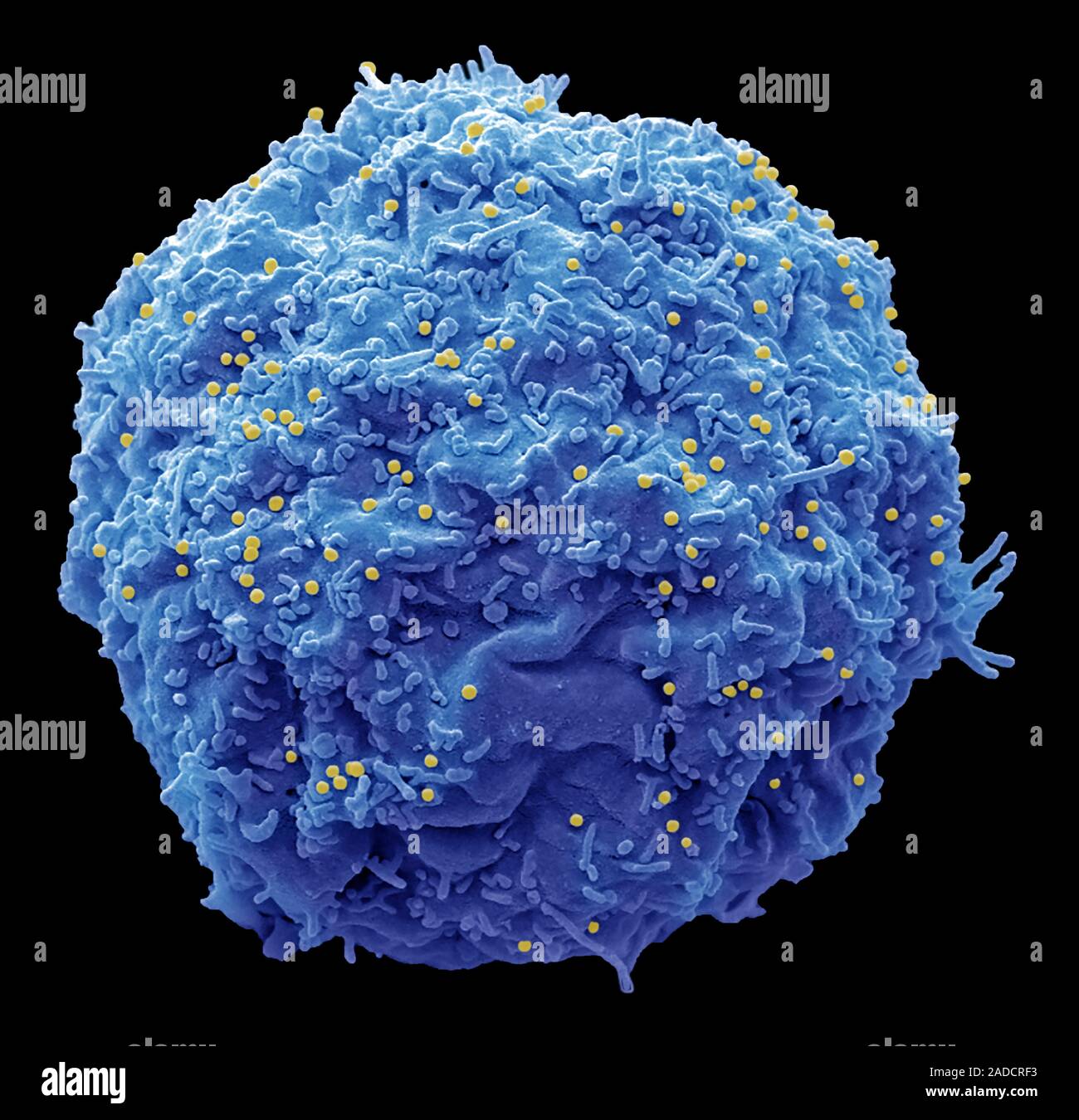 HIV infected 293T cell. Coloured scanning electron micrograph (SEM) of ...