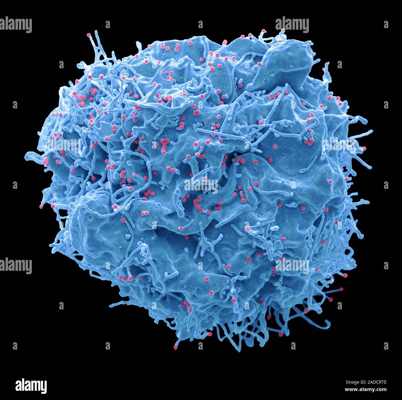 HIV infected 293T cell. Coloured scanning electron micrograph (SEM) of ...