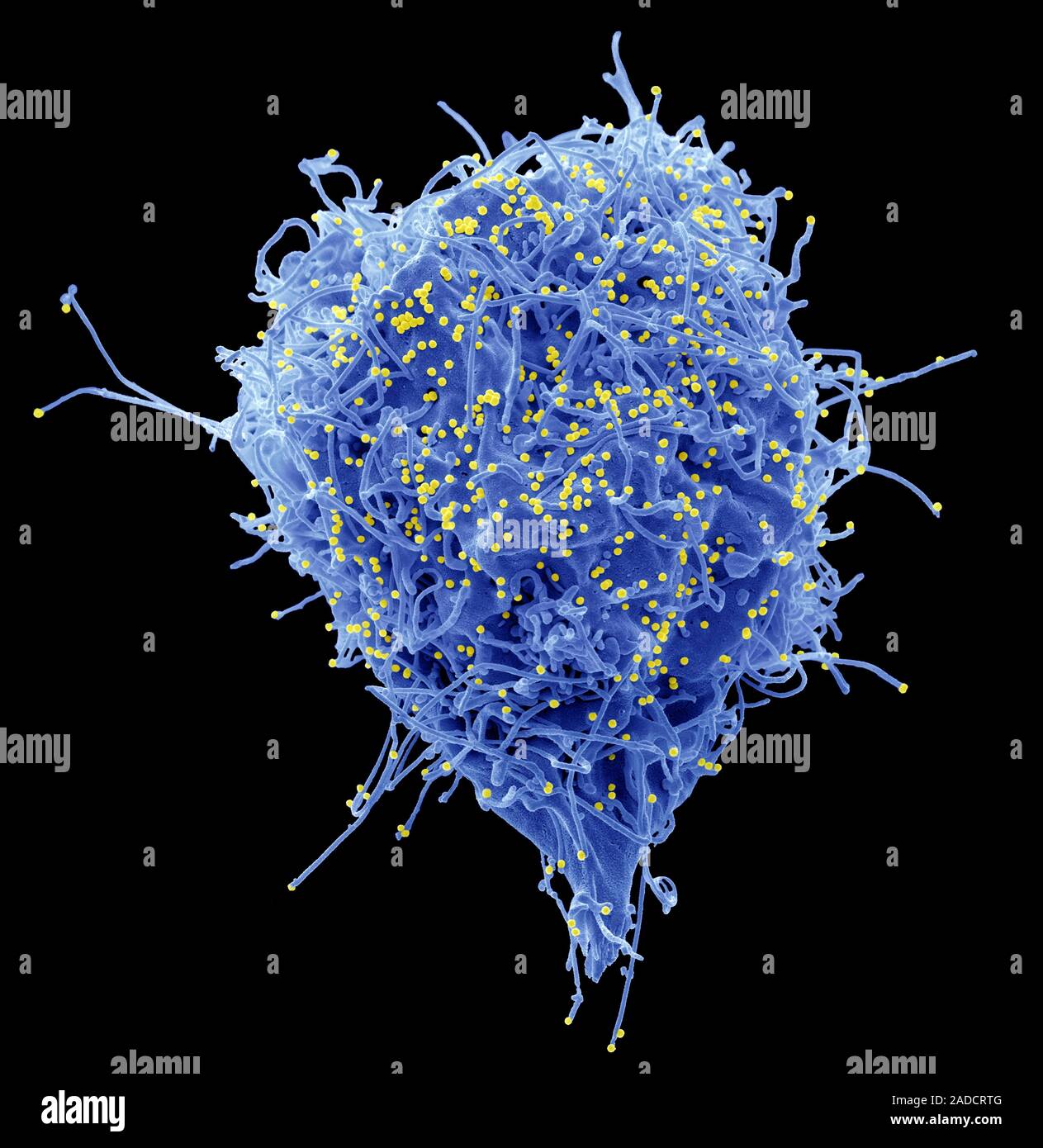 HIV infected 293T cell. Coloured scanning electron micrograph (SEM) of ...