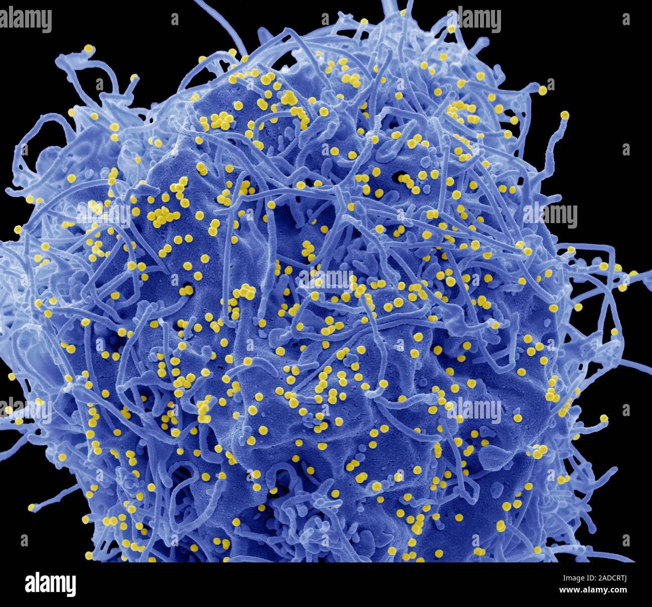 HIV infected 293T cell. Coloured scanning electron micrograph (SEM) of ...