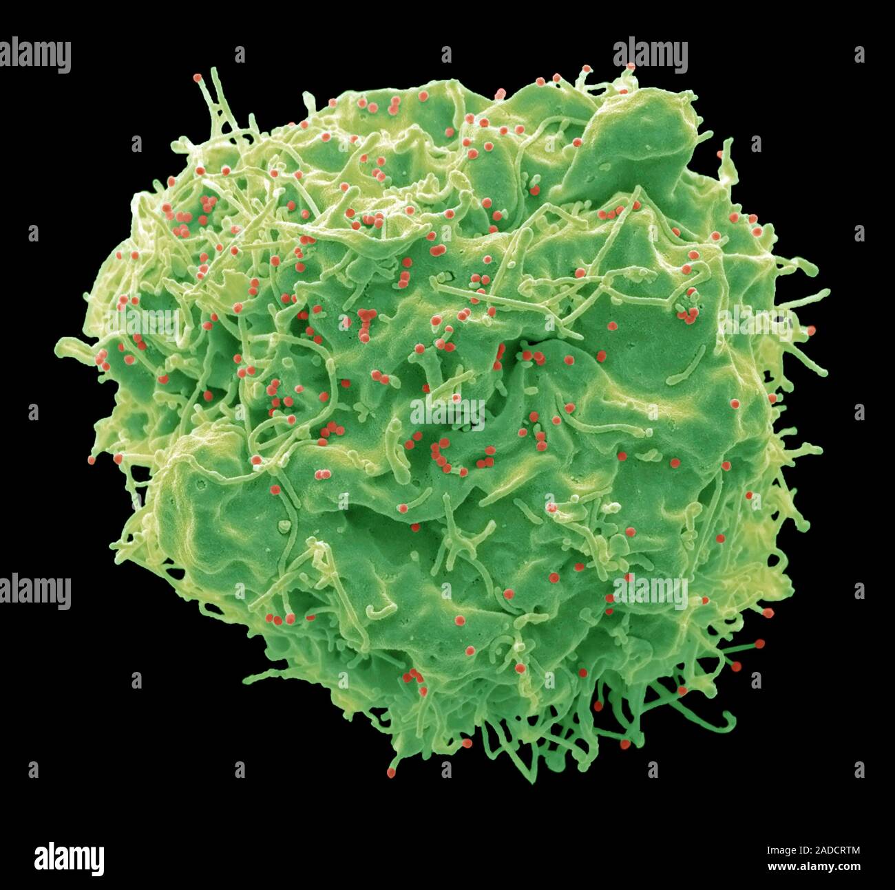 HIV infected 293T cell. Coloured scanning electron micrograph (SEM) of ...