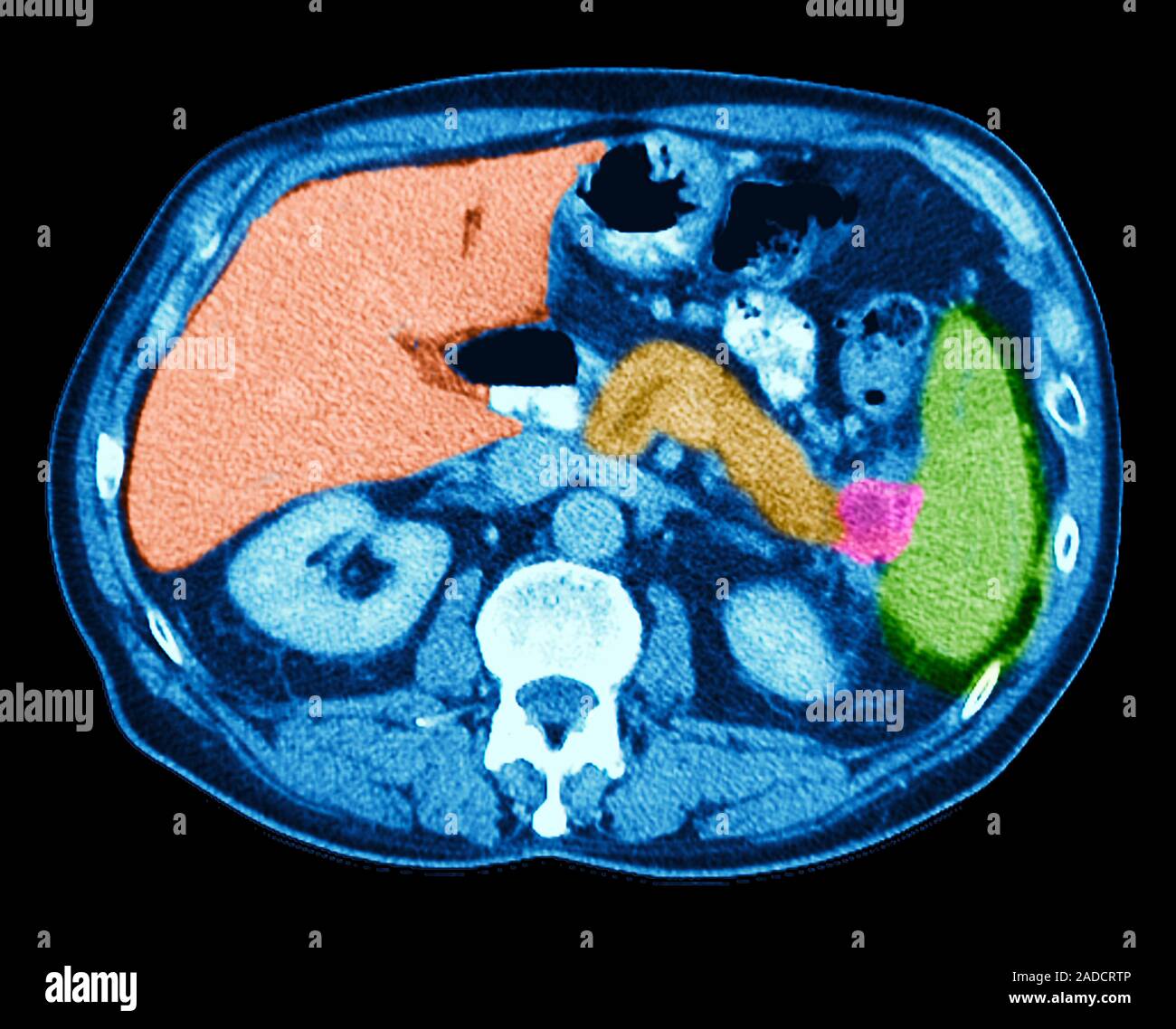 Pancreatic cancer. Axial computed tomography (CT) scan through a 69 ...