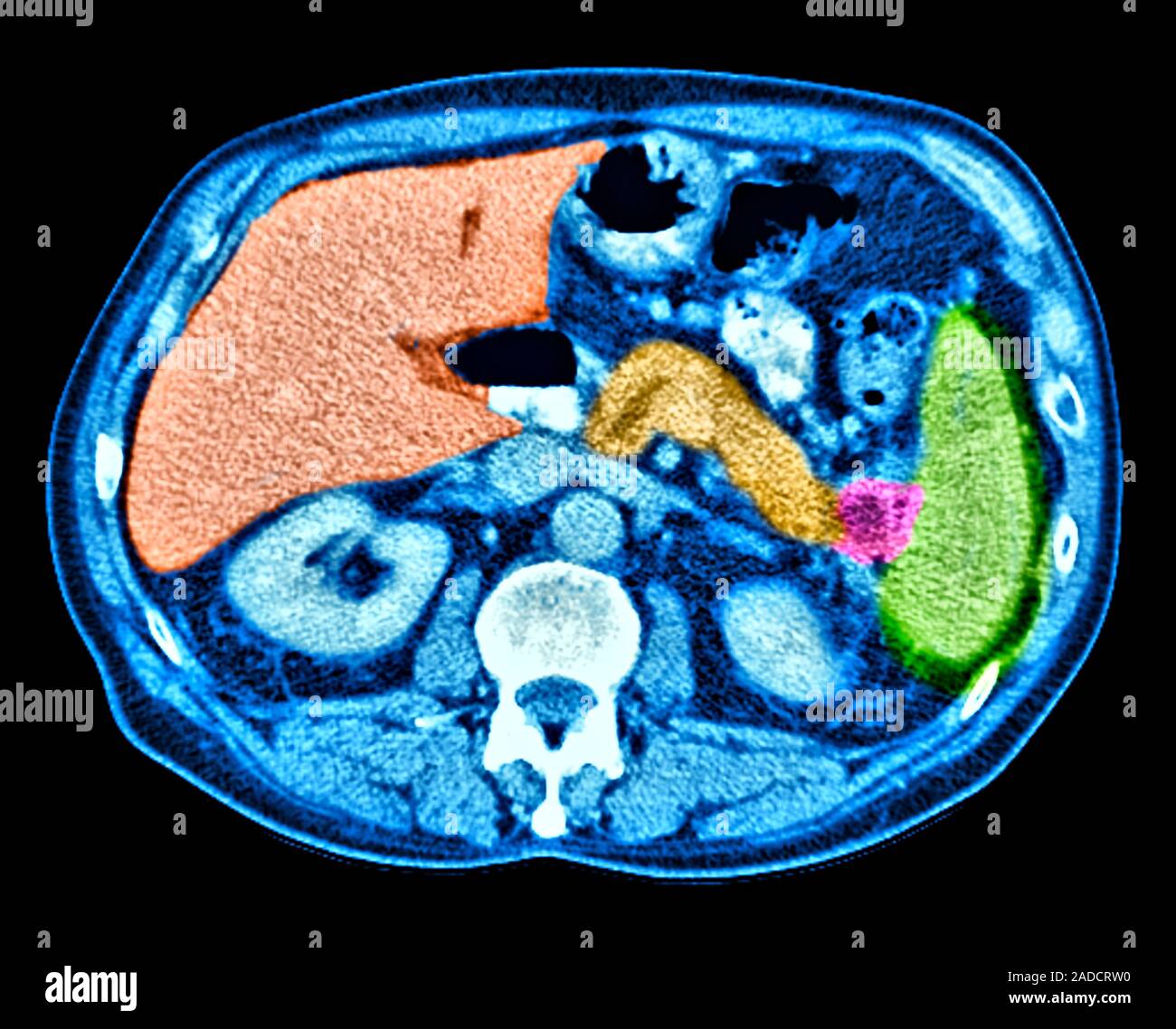 Pancreatic cancer. Axial computed tomography (CT) scan through a 69 ...
