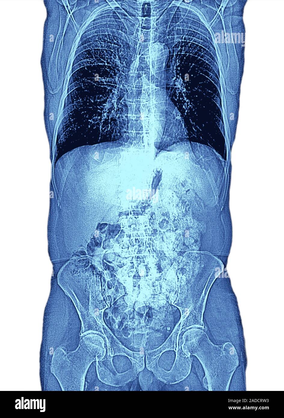 Normal human torso, monochrome frontal CT (computer tomography) scan ...