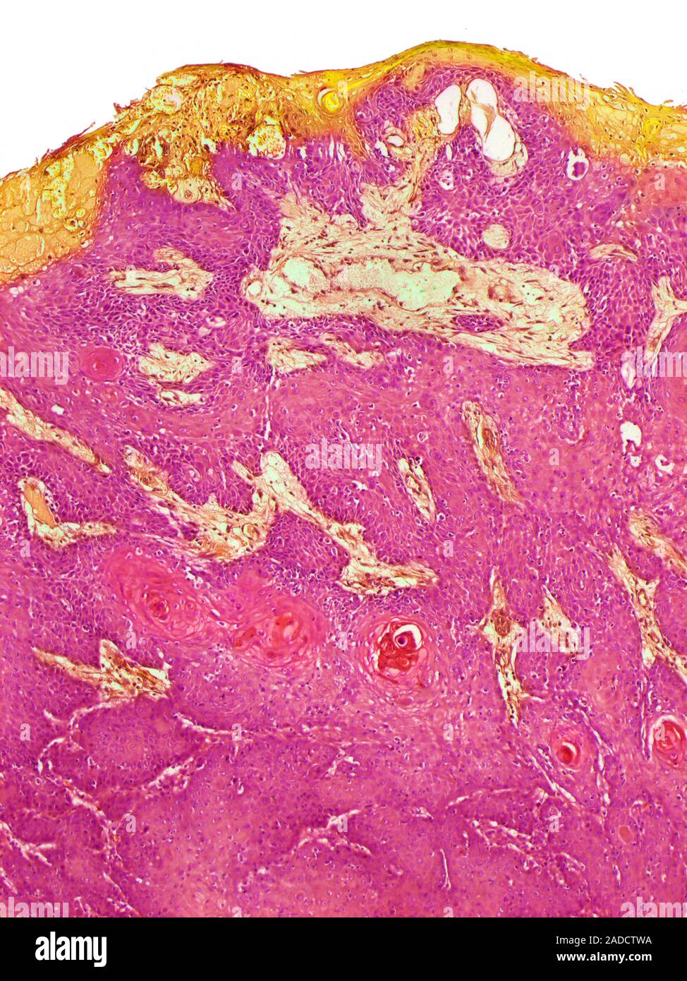 Squamous cell carcinoma (SCC). Light micrograph (LM) of SCC cells (pink ...