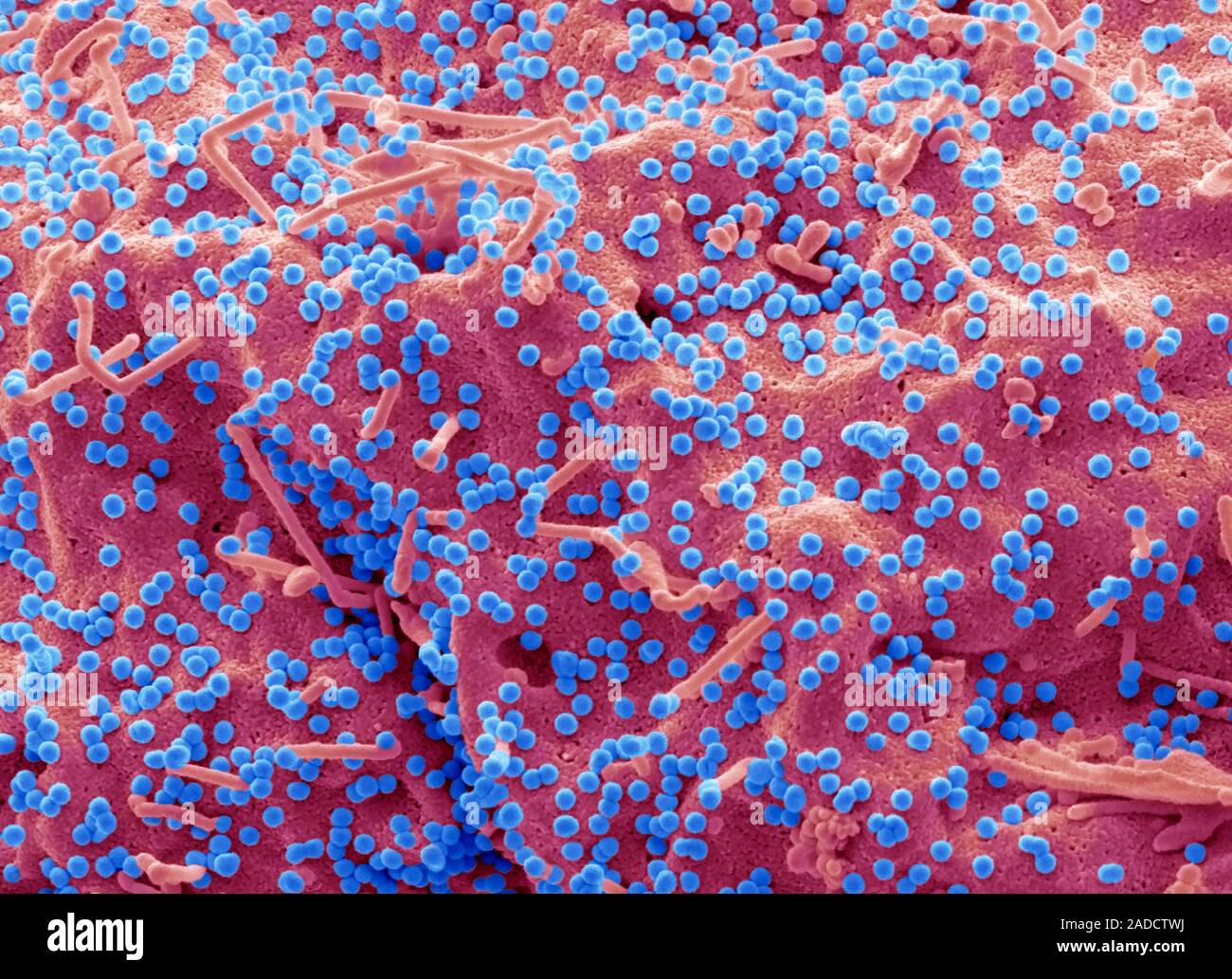 HIV infected 293T cell. Coloured scanning electron micrograph (SEM) of ...