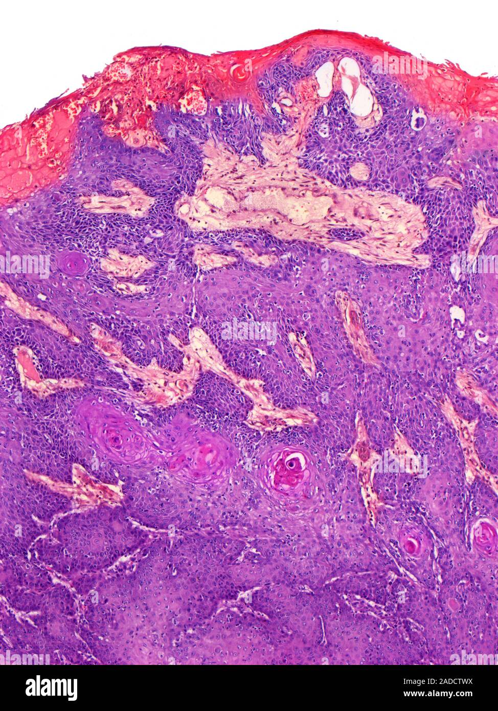 Squamous cell carcinoma (SCC). Light micrograph (LM) of a SCC (purple ...