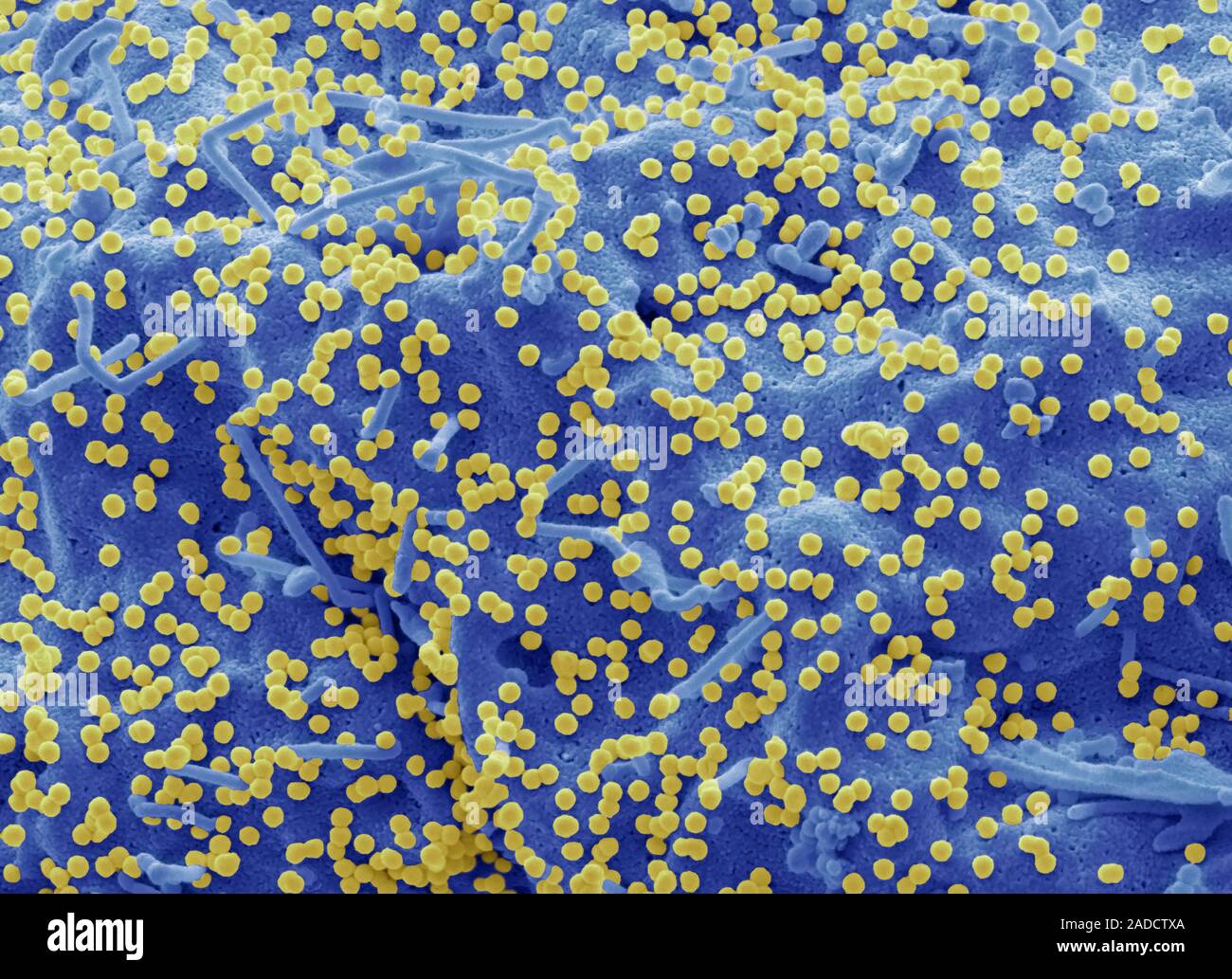 HIV infected 293T cell. Coloured scanning electron micrograph (SEM) of ...