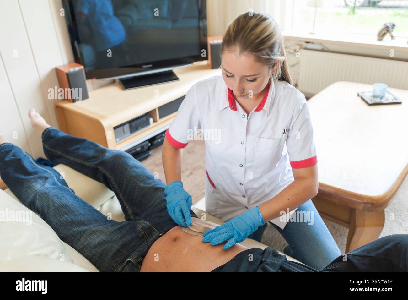 Home care nursing. Nurse applying a colostomy bag to a patient's stoma ...