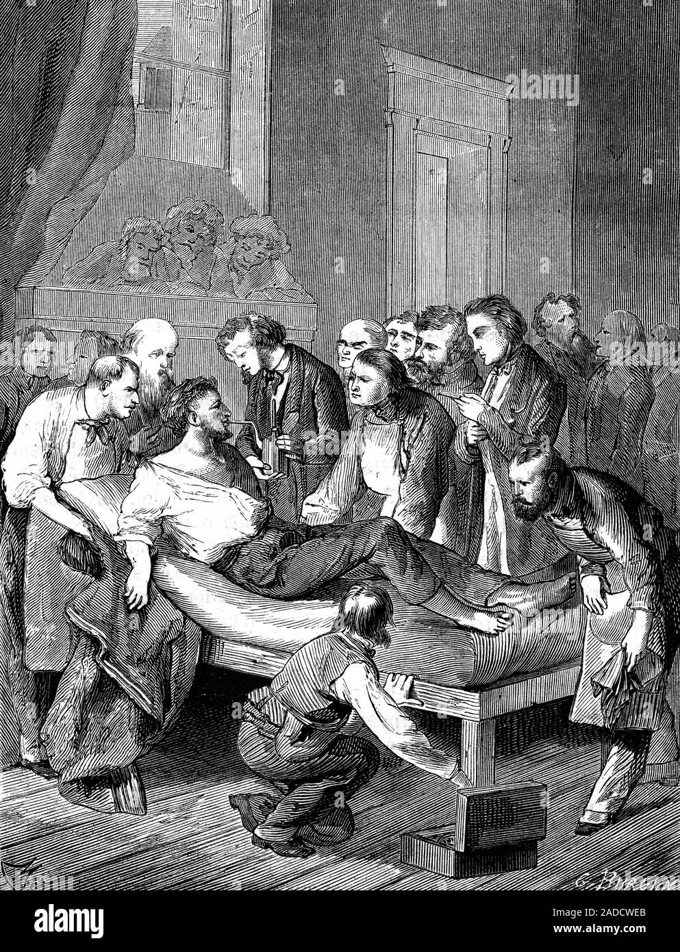 William Morton (1819-1868) using ether anaesthesia. 1868 illustration ...