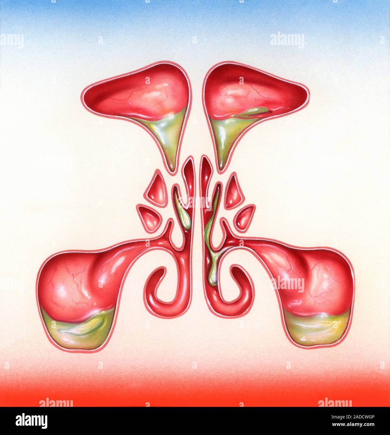 Sinusitis. Illustration of a frontal section through the nasal cavities ...