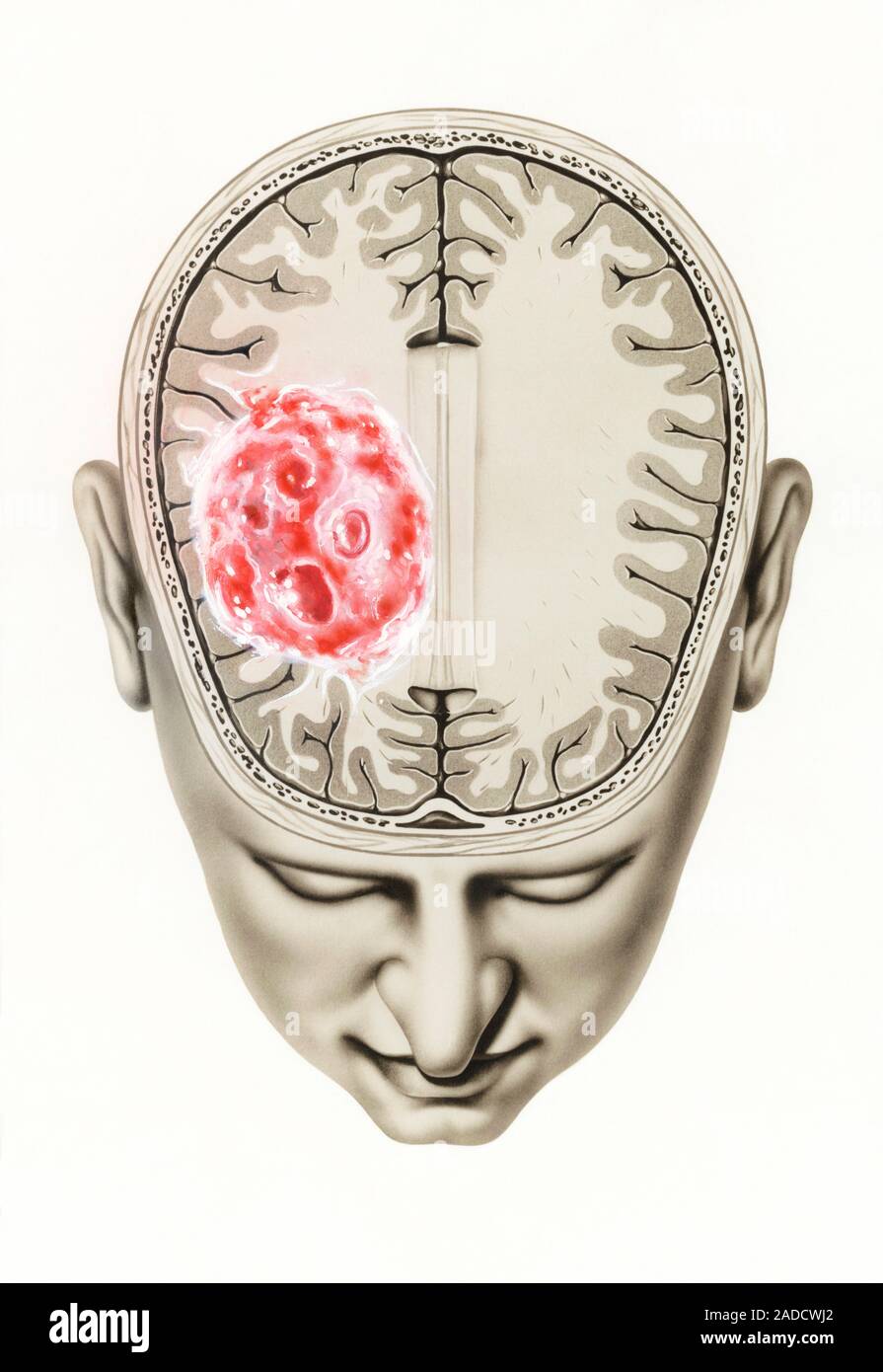 Glioma brain tumour. Illustration of an overhead view of an axial ...