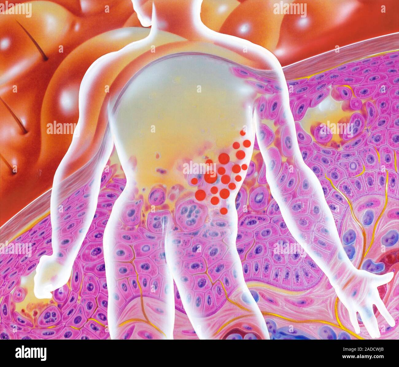 Shingles skin blisters. Illustration of the effect of varicella-zoster ...