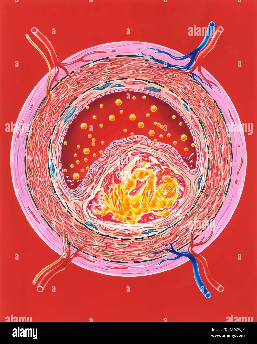 Atherosclerosis in an artery. Illustration of a cross-section through ...