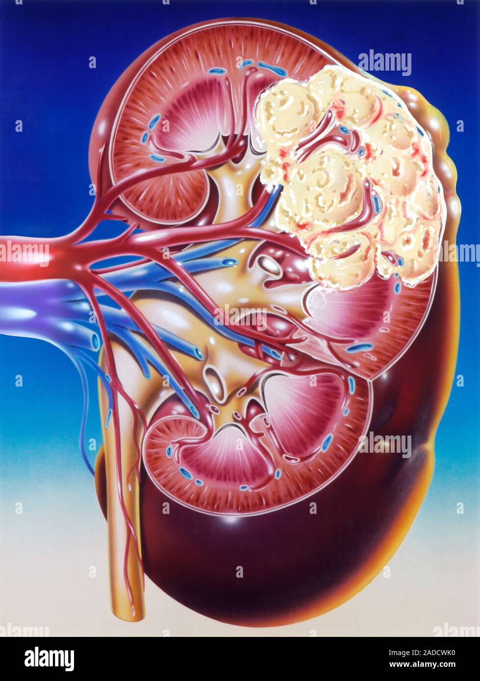 Kidney cancer, illustration. This sectioned view of a kidney shows a ...