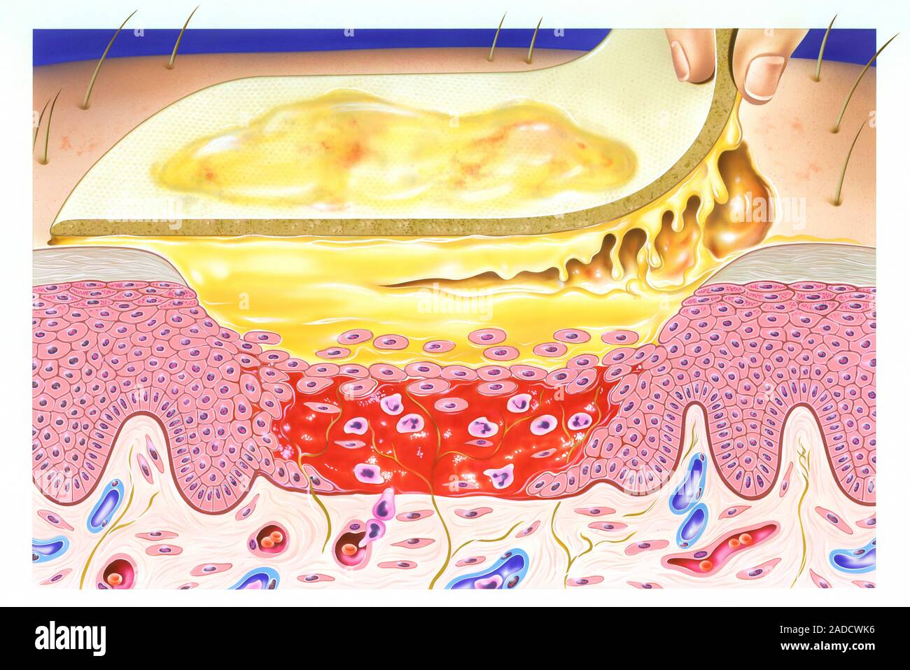 Hydrocolloid woundcare. Illustration of a section through a wound in ...