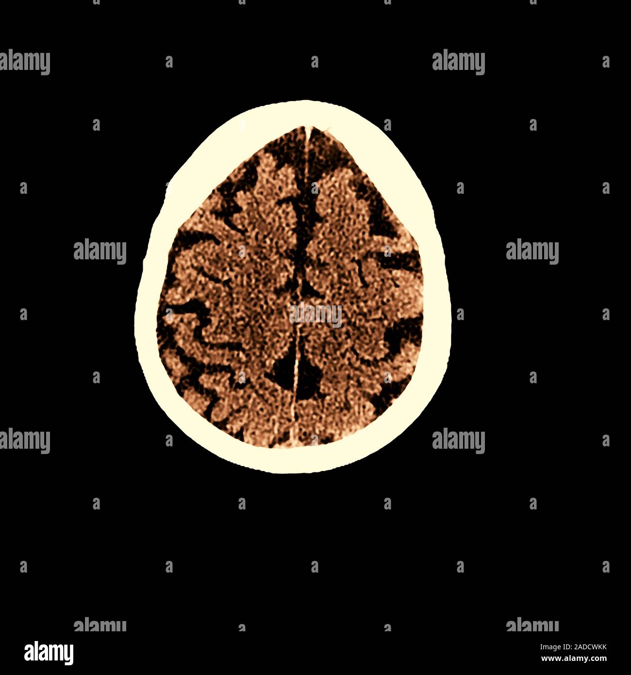 Coloured computed tomography (CT) scan of the brain of an 85 year old ...