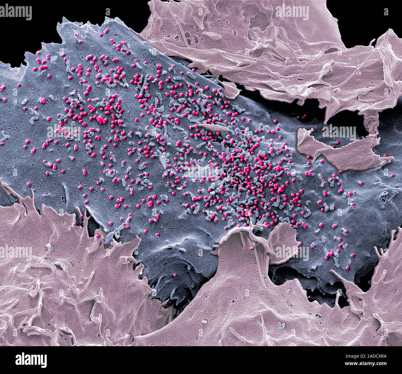 HIV infected 293T cell. Coloured scanning electron micrograph (SEM) of ...