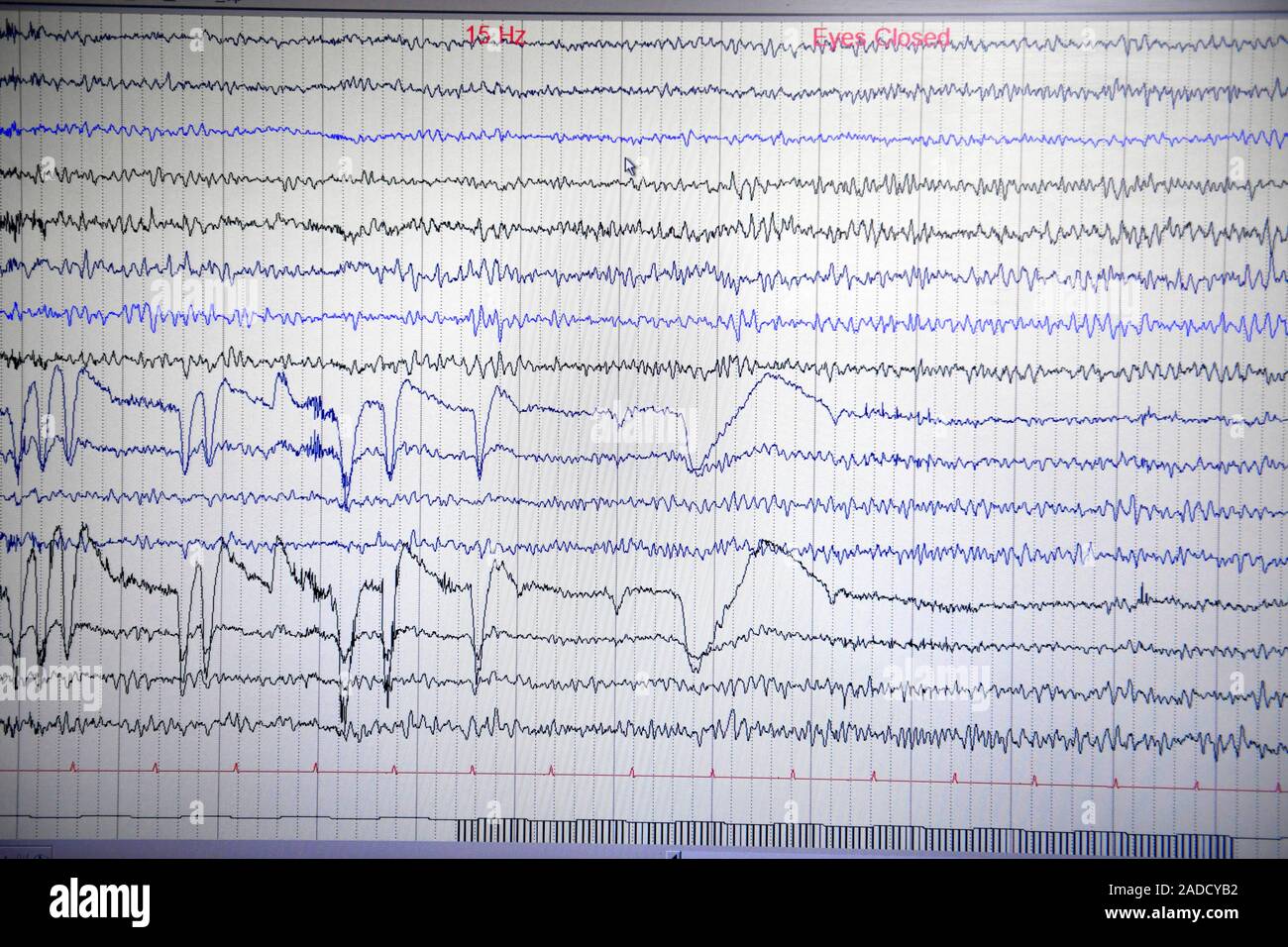 Brain Waves Recorded On An Electroencephalogram Eeg Showing The