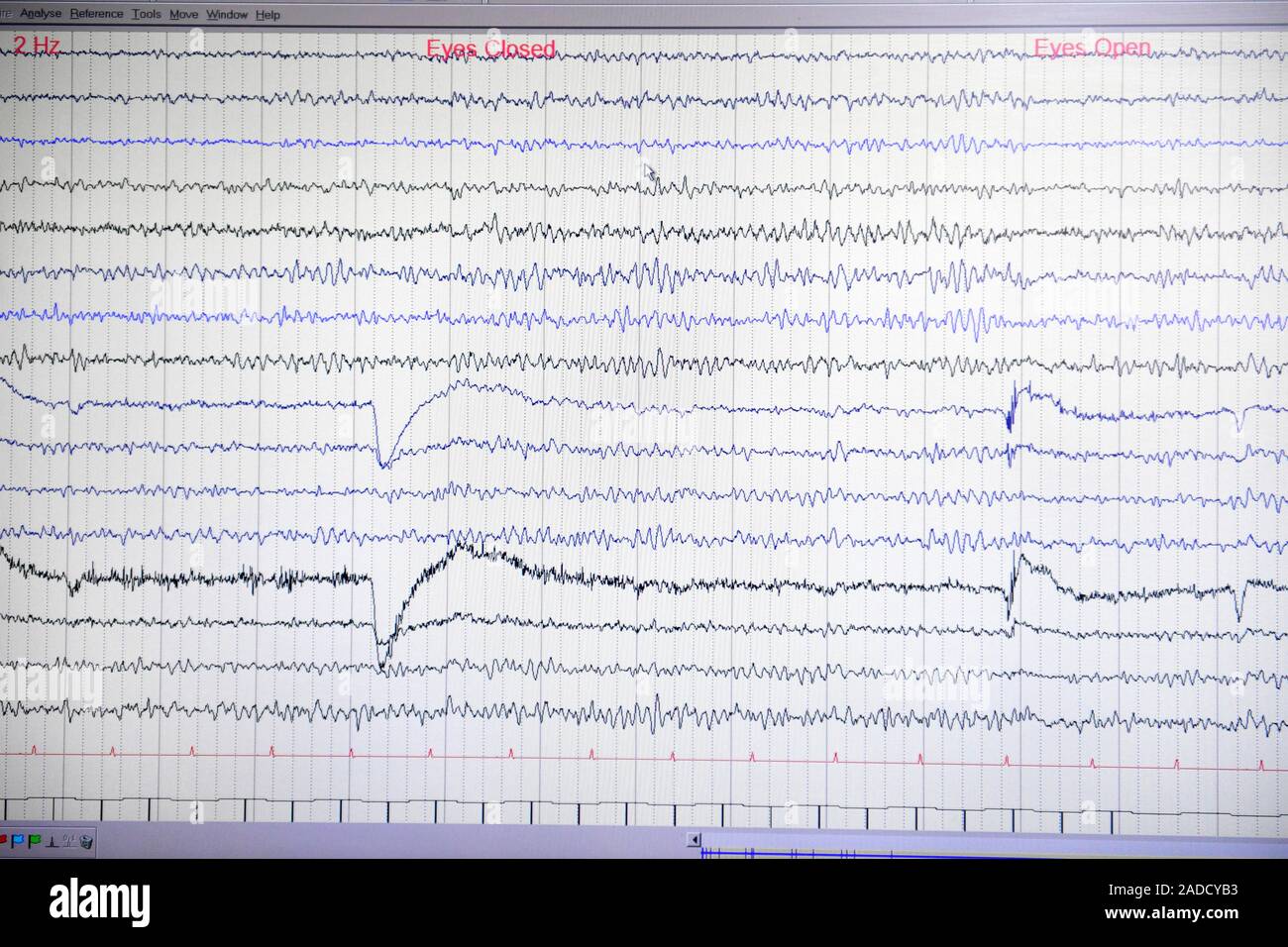 Brain waves recorded on an electroencephalogram (EEG), showing the ...