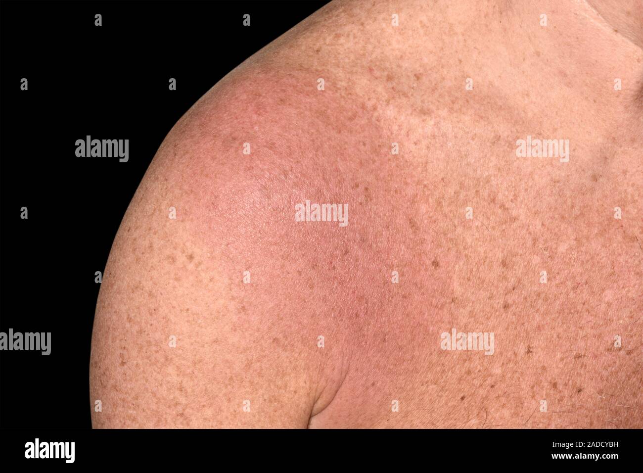 Rash in Lyme's disease on a 58-year-old man's shoulder. Lyme disease is ...