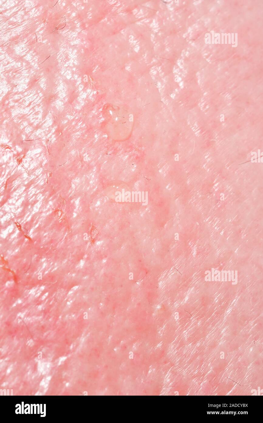 Cellulitis in alcoholic liver disease. Close-up of the skin of a 58 ...