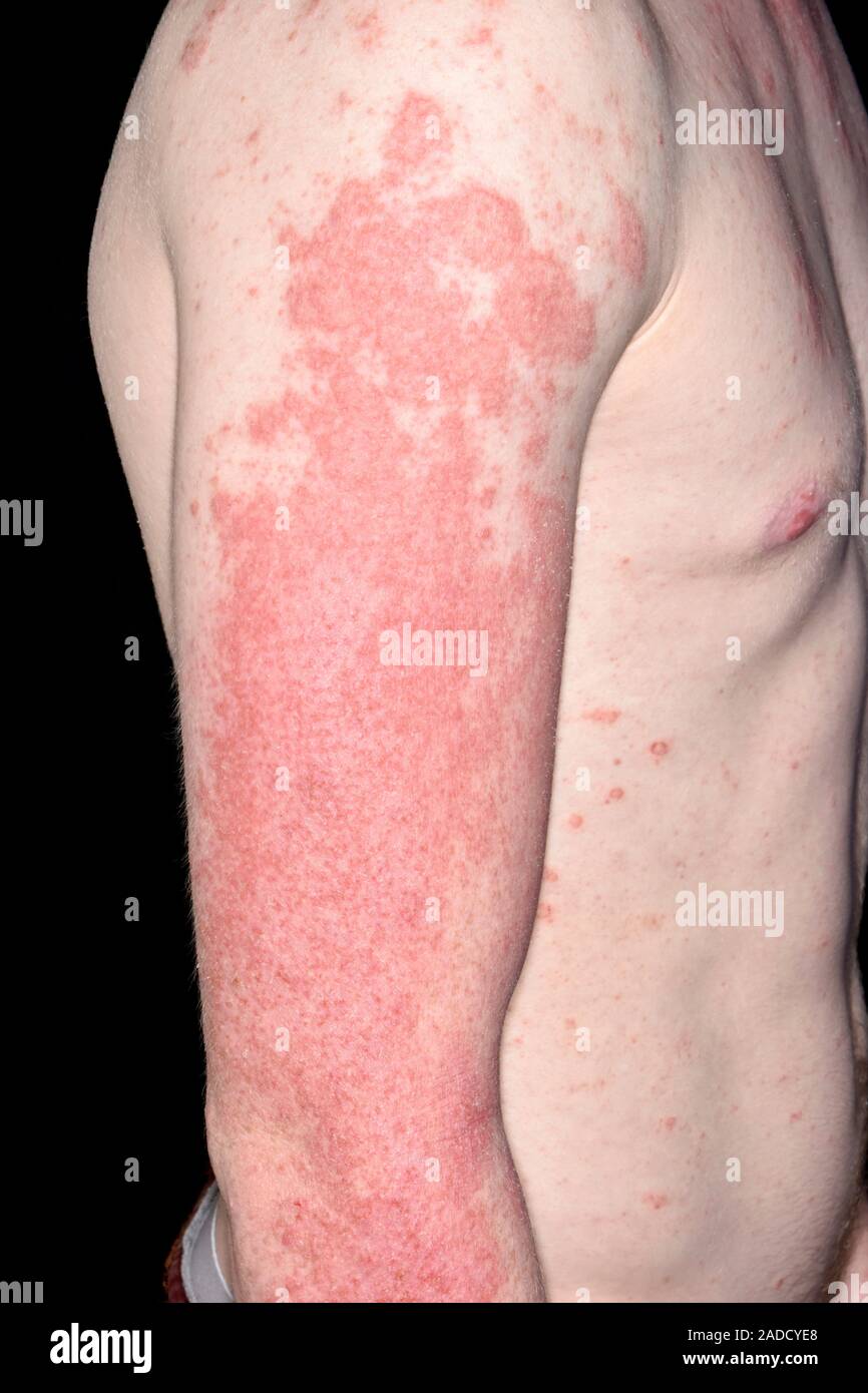 Eczema affecting the skin on the arm of a 21-year-old man. Eczema is an ...