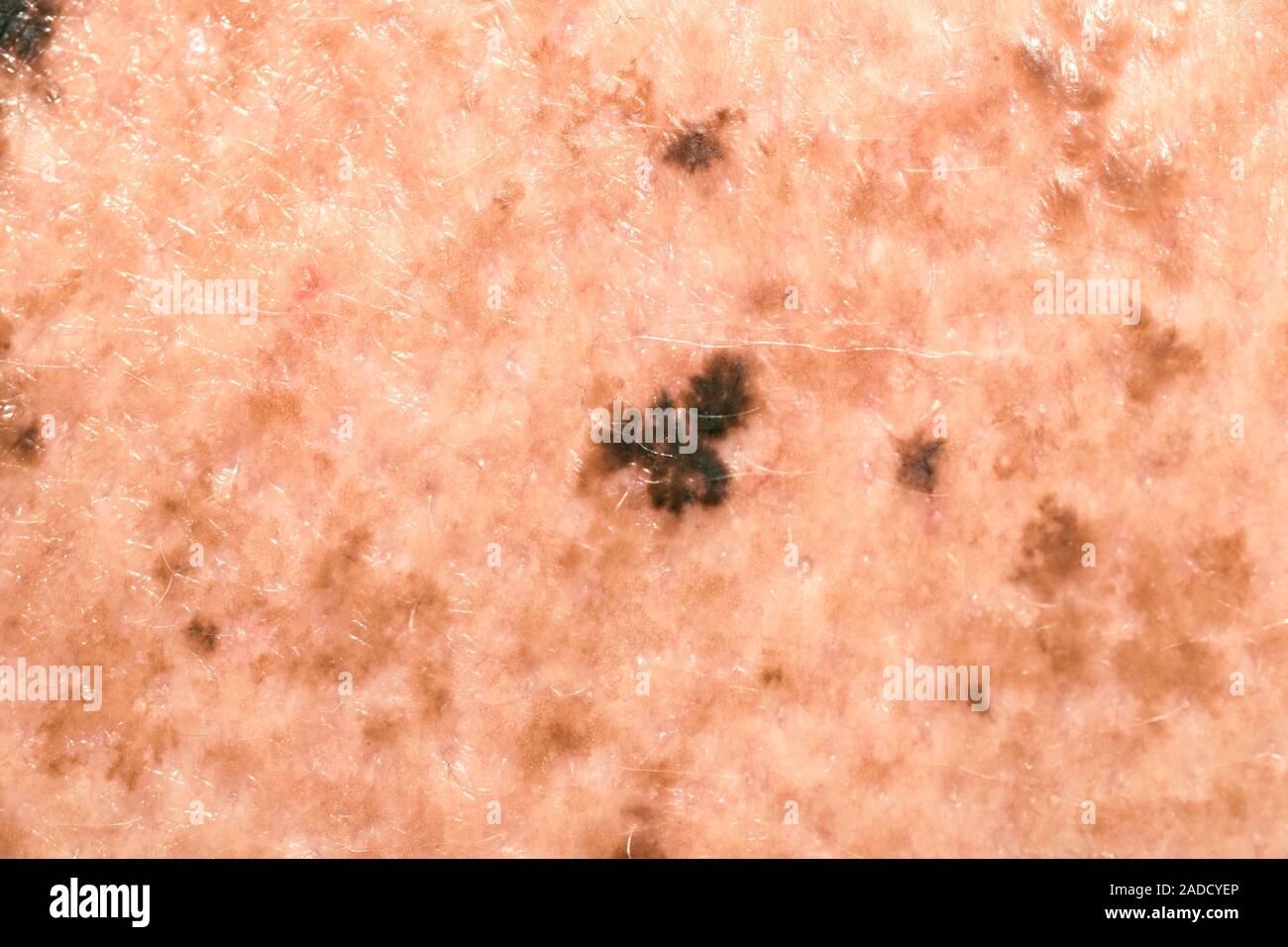 Junctional melanocytic naevus (a type of benign mole) on the skin on ...