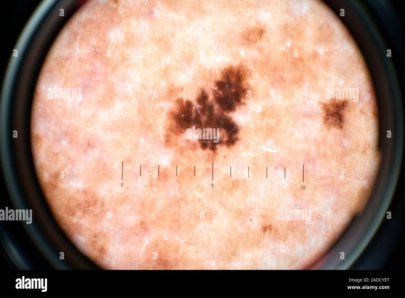 Junctional Naevus Mole On The Skin Stock Image C013 Junctional naevus ...