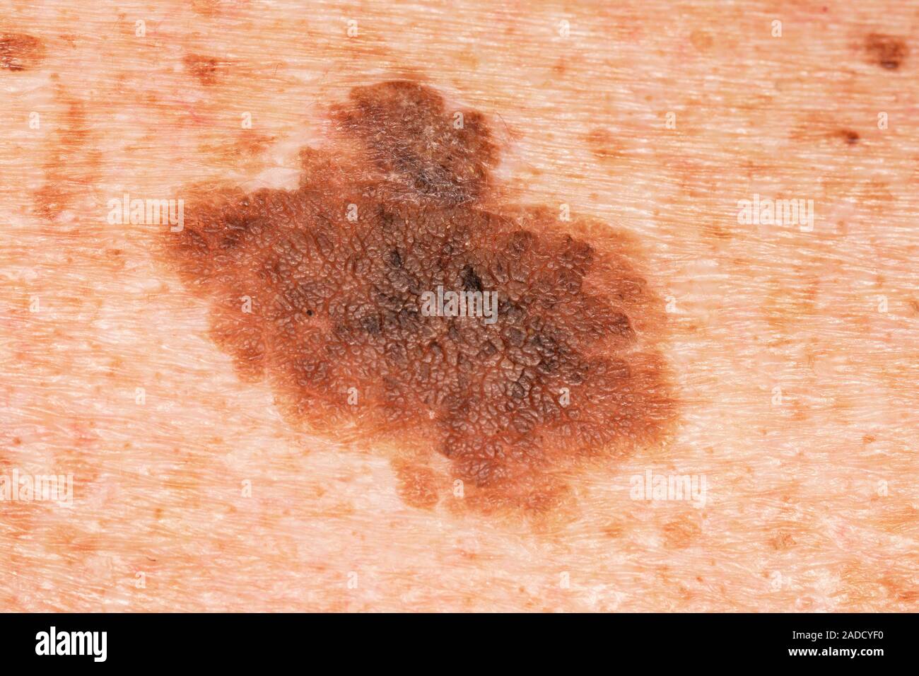 Neurofibroma on the skin of a 70-year-old man. Neurofibroma growths ...
