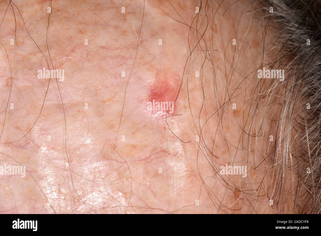 Atypical fibroxanthoma on the scalp of an 86-year-old man, at the edge ...