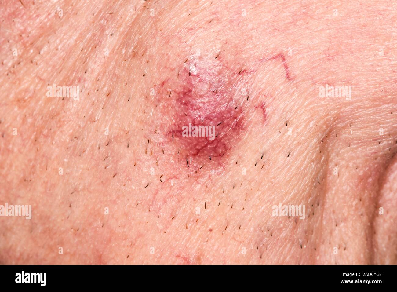 Merkel cell carcinoma (MCC) on the cheek of a 90-year-old man. Merkel ...