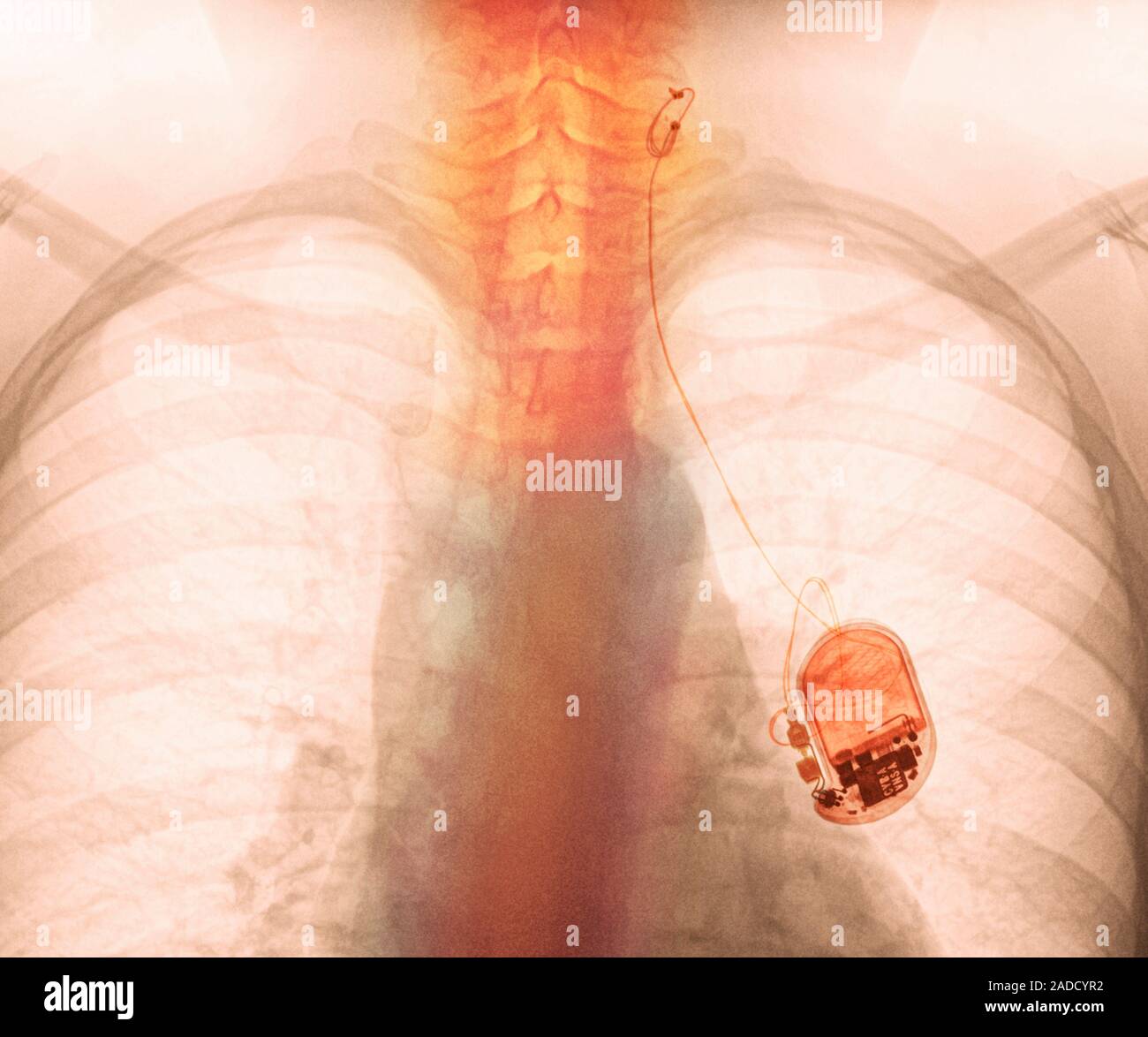 Coloured X-ray of a vagus nerve stimulator (right) implanted in a 30 ...